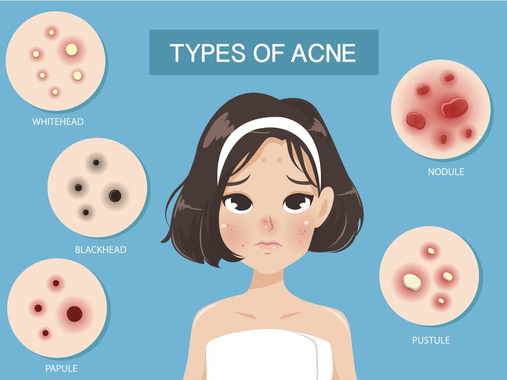 Adult acne & breakouts | Bloom Clinic